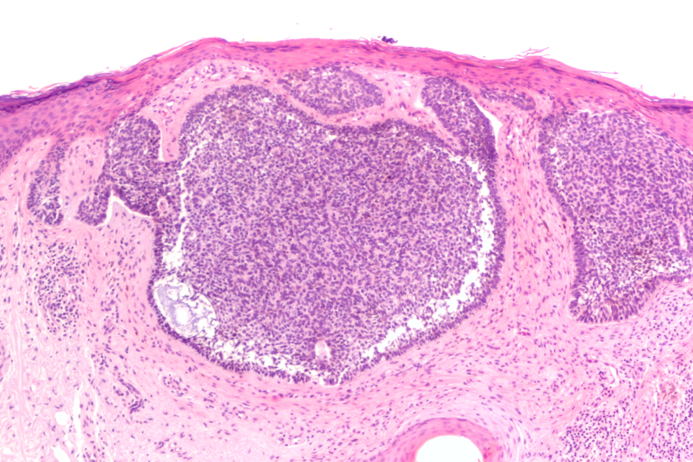 Mohs Surgery for Skin Cancer Near Chattanooga | Uderm